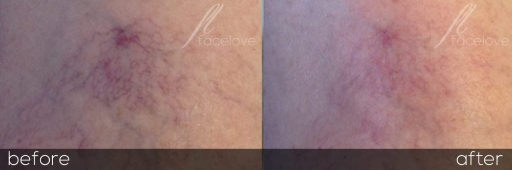 Capillary redness reduction treatment facelove - Facelove