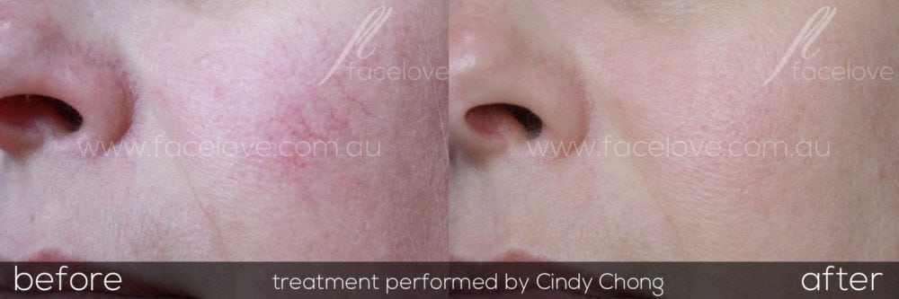 Capillary redness reduction treatment with LED therapy - Facelove