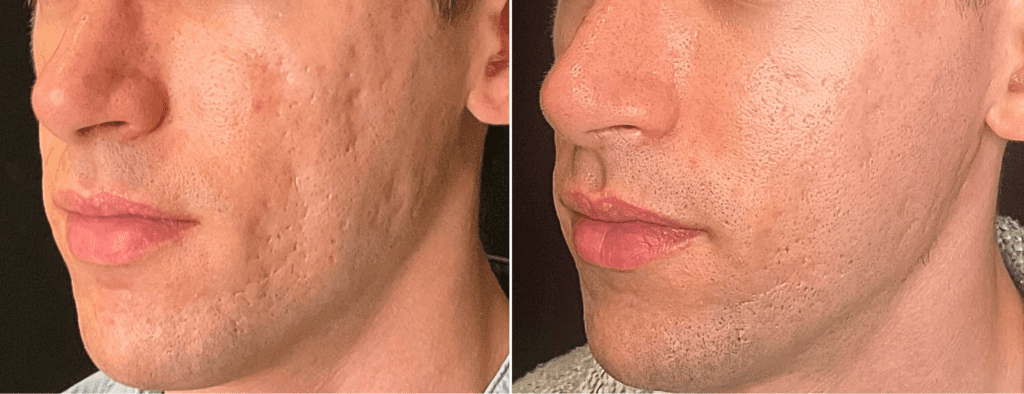 Exosomes for Skin - Facelove - St Kilda, Melbourne