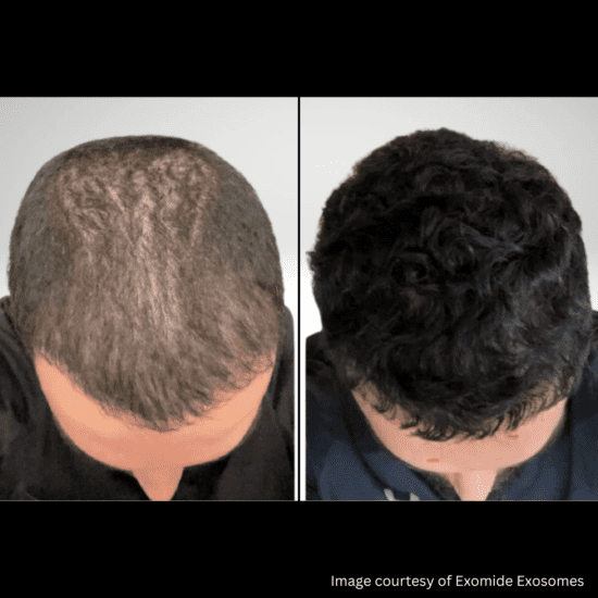 Exosomes for Hair - Facelove - St Kilda, Melbourne