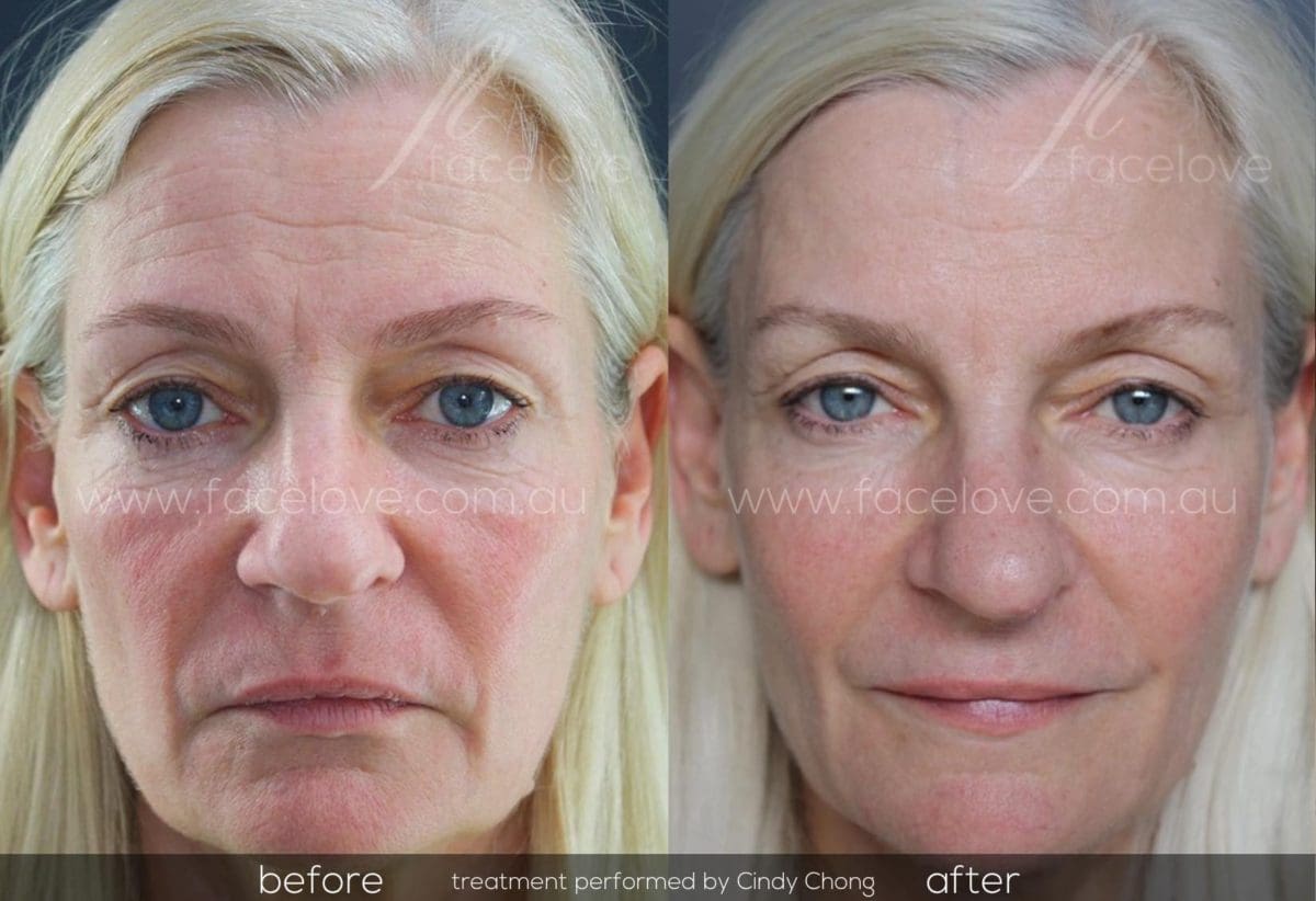 Dermal Filler Treatment