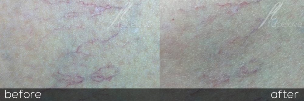 Capillary redness reduction treatment - Facelove