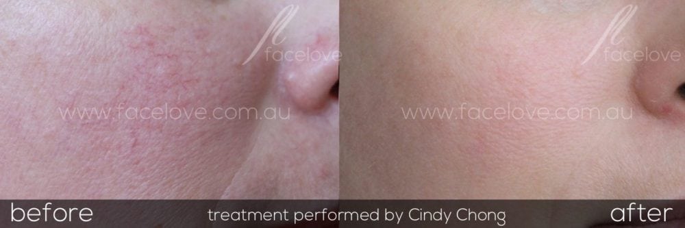 Get rid of facial capillaries melbourne - Facelove