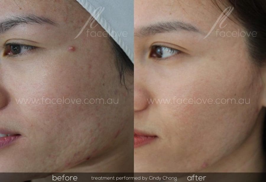 Collagen Induction Therapy (CIT) Dermapen Skin Needling - Facelove - St ...