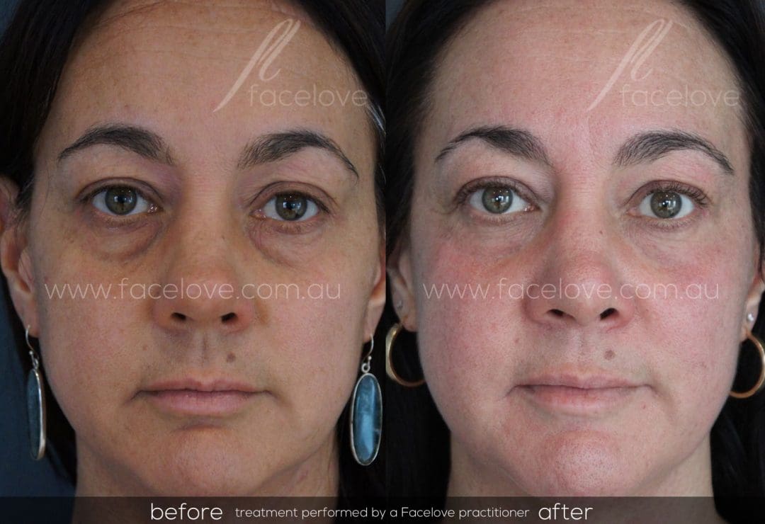 Skin Tightening with The Secret Micro-Needle Fractional RF - Facelove ...