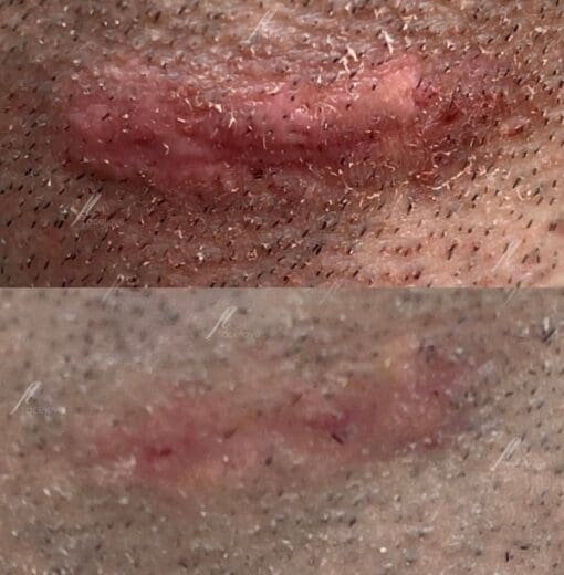 Scar Treatments - Facelove - St Kilda, Melbourne